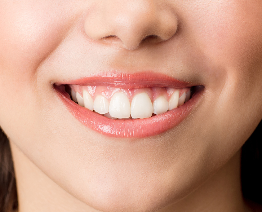 Ästhetische Zahnmedizin - Veneers, Bleaching, Zahnaufhellung, Invisalign